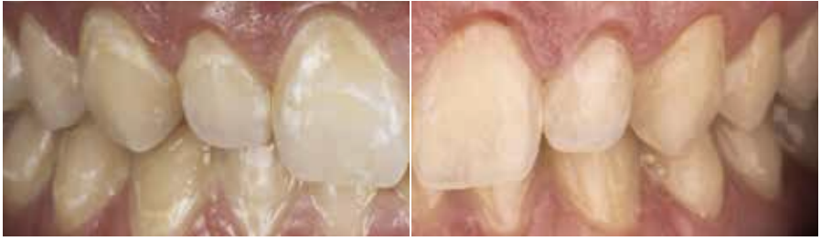 Icon White Spot Treatment | Orchard House Dental Beckenham